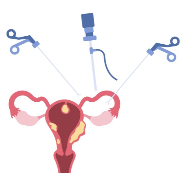 Laparoscopy Hysteroscopy Surgery In Delhi By Veramed Fertility And Ivf